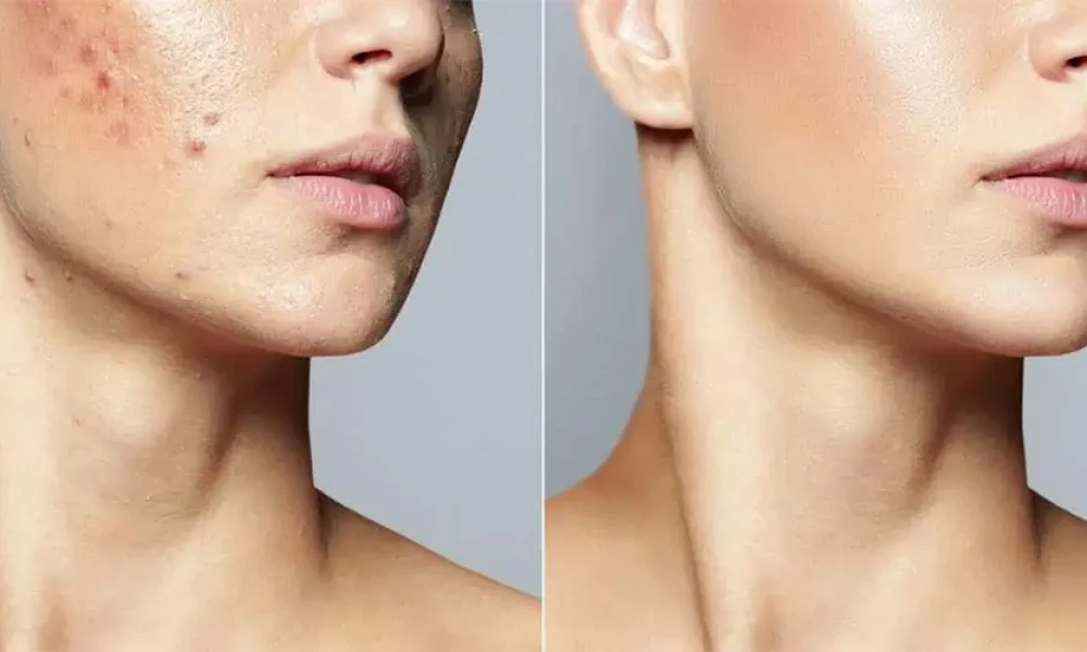 The Complete Acne Scar Guide: Types, Causes, & Their Impact